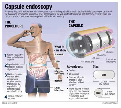 Image result for Endoscopy Small Intestine