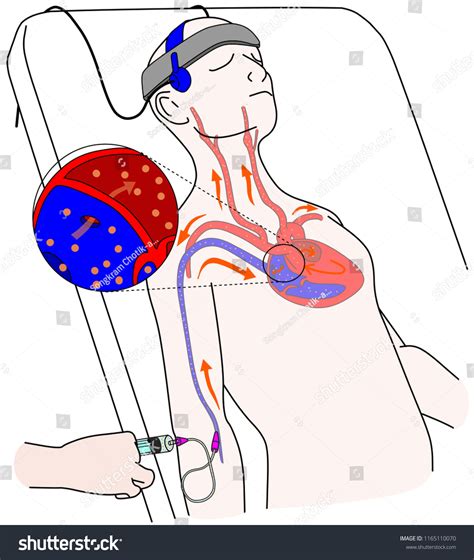 Image result for Intrapulmonary Shunt Bubble Study