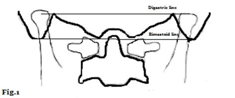 Assessment of basilar invagination | Radiology Case | Radiopaedia.org ...