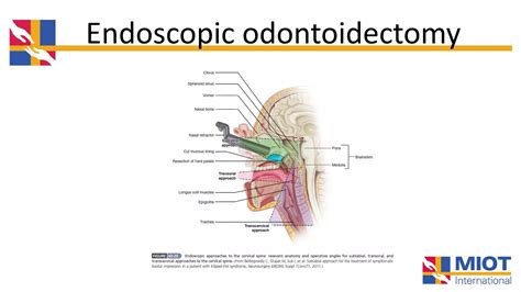 Image result for Basilary Invagination