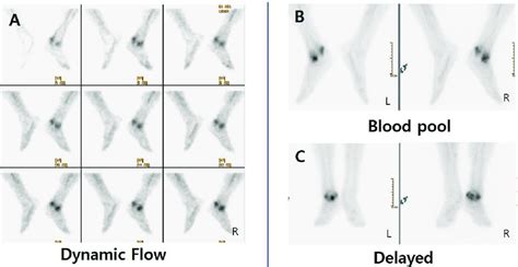 Image result for Triple Phase Bone Scan