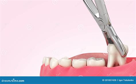 Image result for Tooth Extraction Clamp