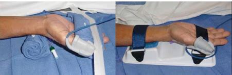 Image result for Angiogram Radial