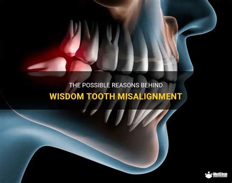 Image result for Wisdom Tooth Overlap