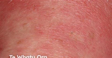 Image result for Types of Pustular Psoriasis