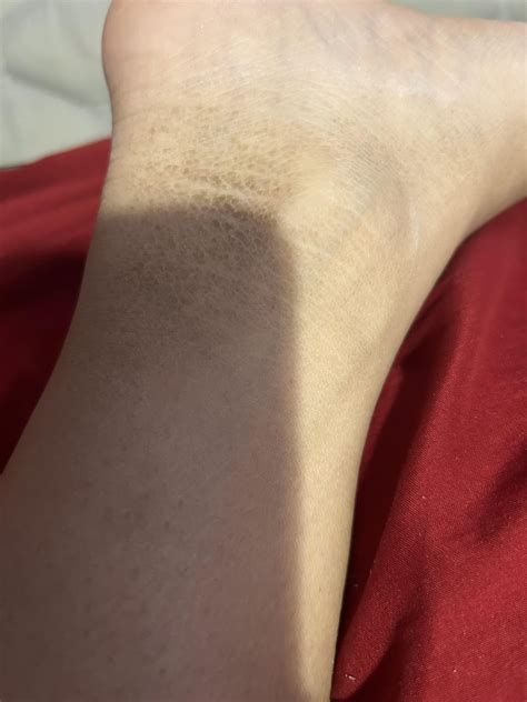 Image result for Scleroderma Skin