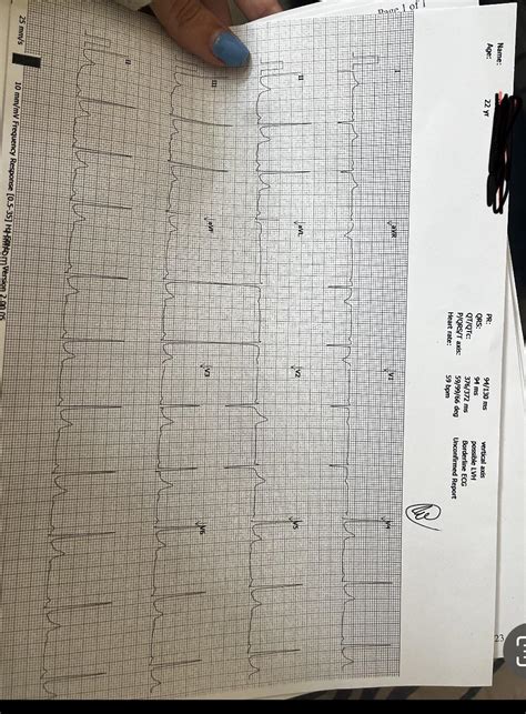 Image result for Types of ST Depression