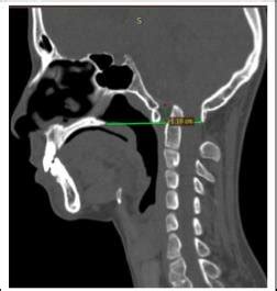 Image result for X-Rays for Basilar Invagination