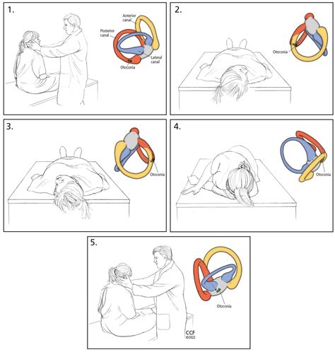 Epley Maneuver Instructions How To Do The Epley Maneuver At, 53% OFF