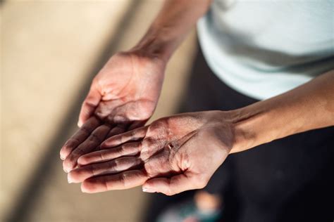 Image result for How to Remove Calluses From Hand