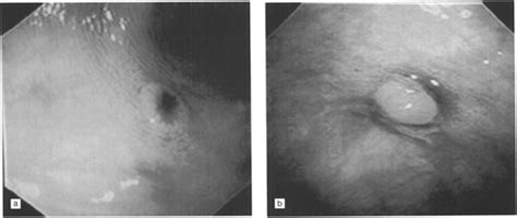 Image result for Control Colonoscopy of Polyps