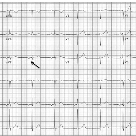 Image result for AV Block PR Interval