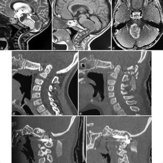 Image result for X-Rays for Basilar Invagination