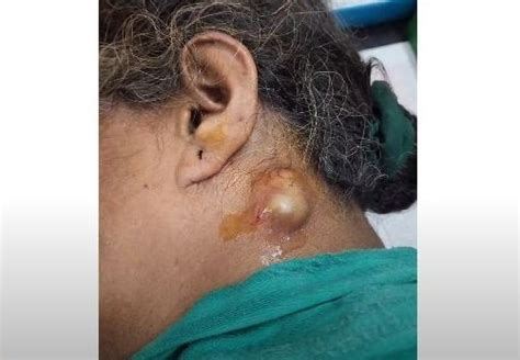 Image result for Big Exploding Cyst Neck