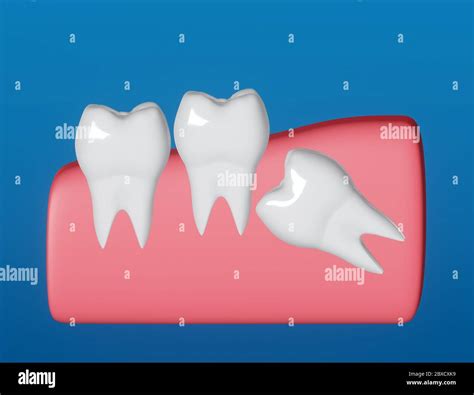 Image result for Wisdom Tooth Overlap