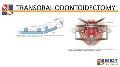 Image result for Basilary Invagination