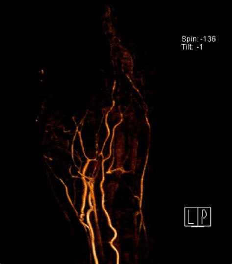 Image result for Angiogram Radial