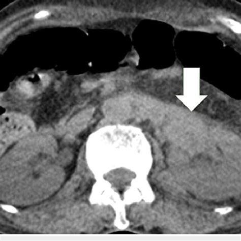 Image result for Urogram CT Scan with Contrast Normal