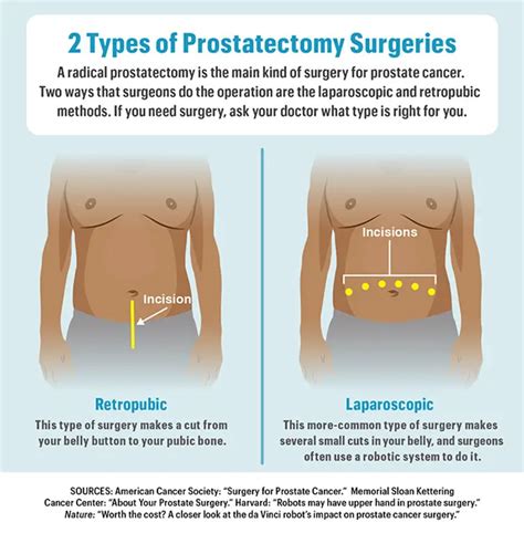 Image result for Simple vs Radical Prostatectomy