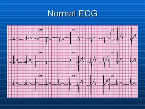 Image result for Normal ECG Range Chart