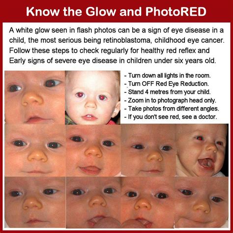 Image result for Red Reflex