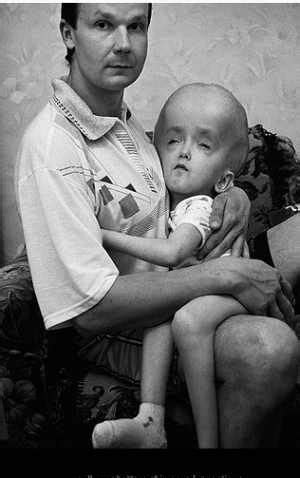 Image result for Chernobyl Disaster Human