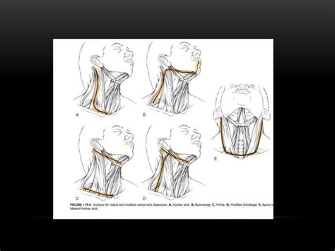 Image result for Types of Neck Dissection