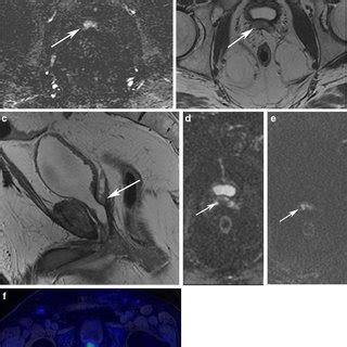 Image result for Post-Prostatectomy