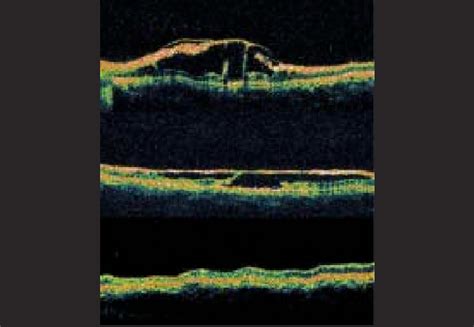 Image result for Oct Line Scan