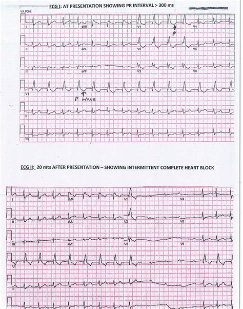 Image result for 300Ms PR Interval