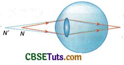 Image result for Vision Defects Myopia