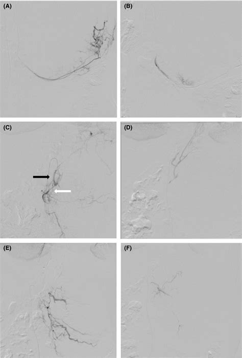 Image result for Angiogram with Embolization