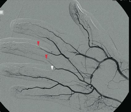 Image result for Hand Angiogram