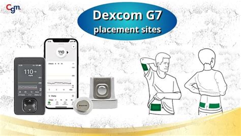 Image result for Dexcom Sensor Placement
