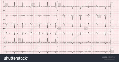 Image result for Normal EcG