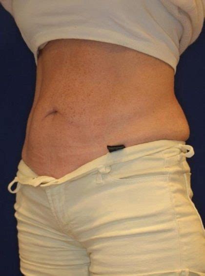 Patient #14228 Body Contouring Before and After Photos New York, NY ...