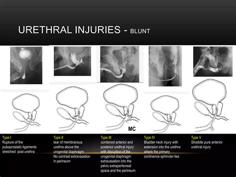 Image result for Acending Urethrogram