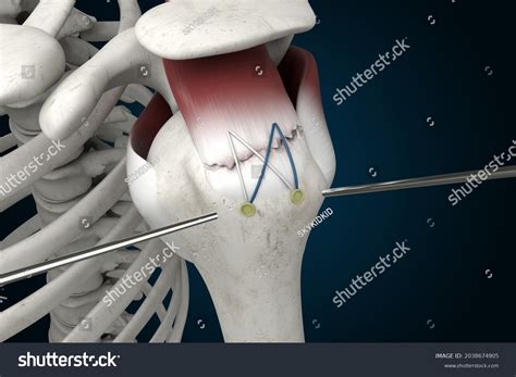 Image result for Rotator Cuff Repair Surgery