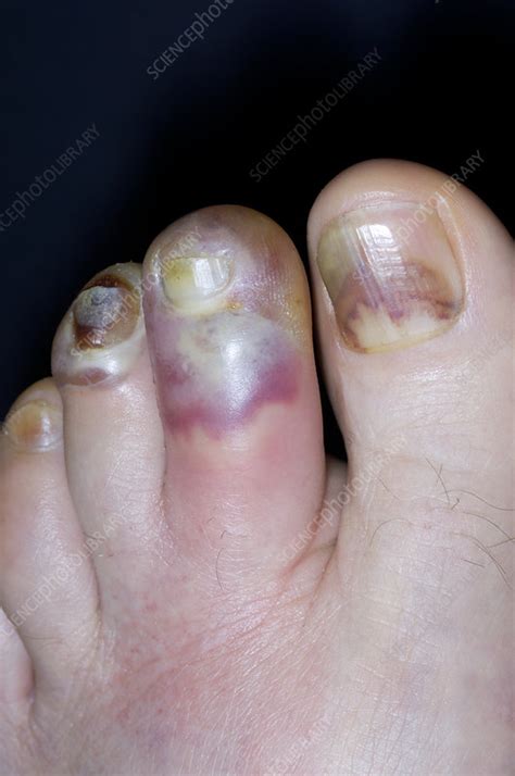Image result for Cellulitis Toe