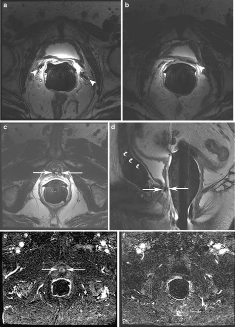 Image result for Post-Prostatectomy