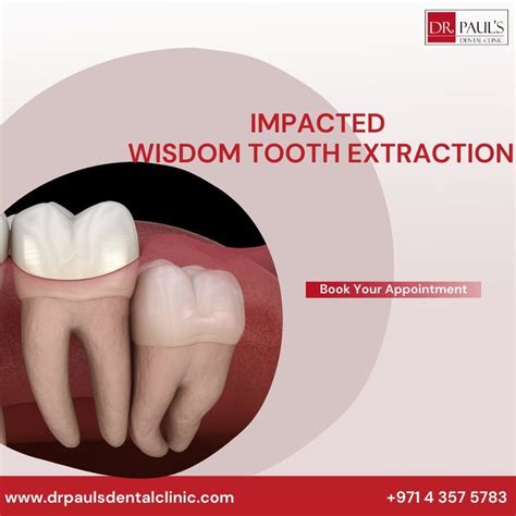 Image result for Impacted Wisdom Tooth Extraction