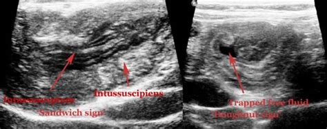 Image result for Pronounce Intussusception