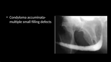 Image result for Acending Urethrogram