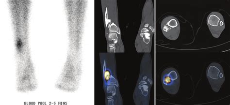 Image result for Triple Phase Bone Scan