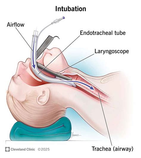 Image result for How to Do Intubation