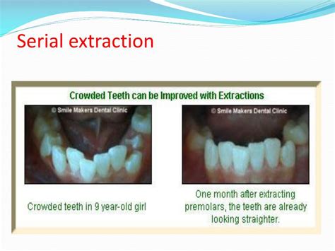 Image result for Serial Extraction Process
