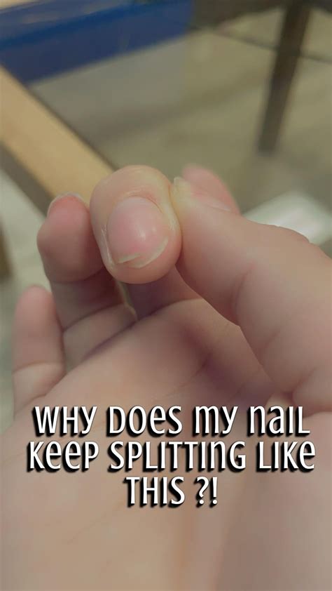 Image result for Help for Splitting Nails Shea Butter