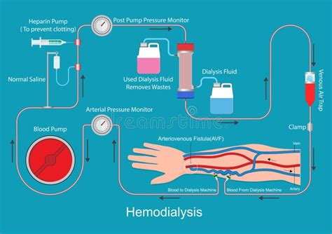 Image result for How Does a Dialysis Machine Work