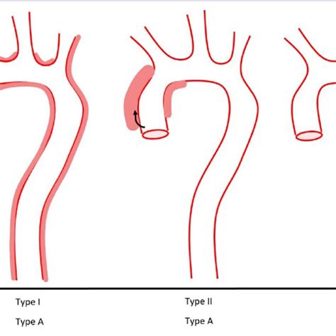 Image result for Type 2 Aortic Dissection