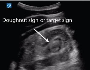 Image result for Intussusception Pseudokidney Sign